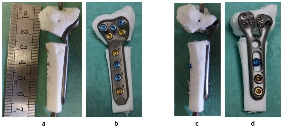 Comparing two metal plates to correct malunited wrist fractures ...